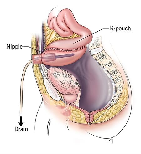 kock pouch procedure