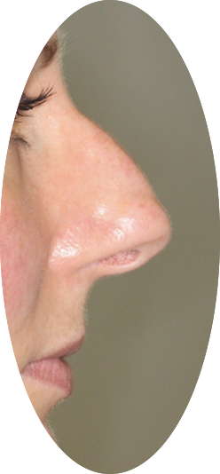 Info zu verschiedenen Nasenformen - Dr. Kovacevic