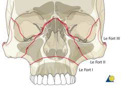 les fractures du massif facial et de la mandibule - Site de le-monde-d ...