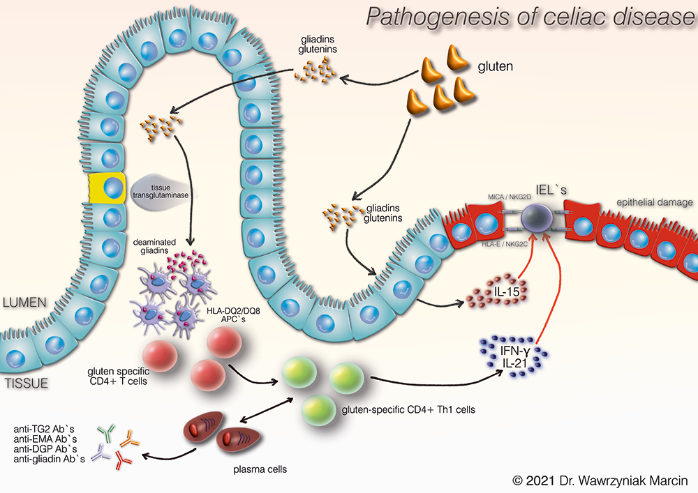 The role of epithelial cells differentiation in the pathogenesis of ...