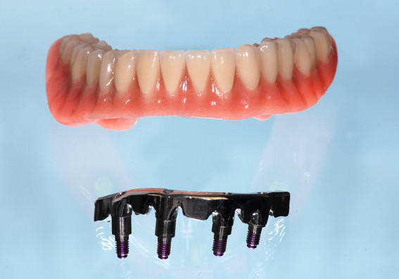 Stegprothese - mm-dentallabor