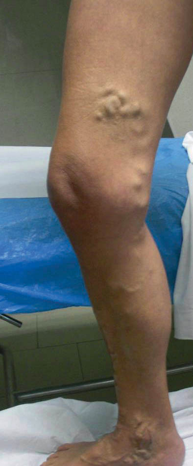 La cura delle varici: tecniche mini invasive. - Benvenuti su nuovafinanza!