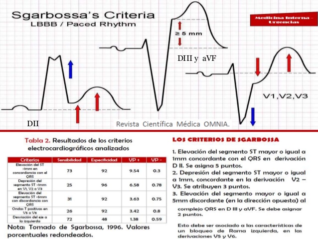 Criterios de Sgarbossa - Aurum