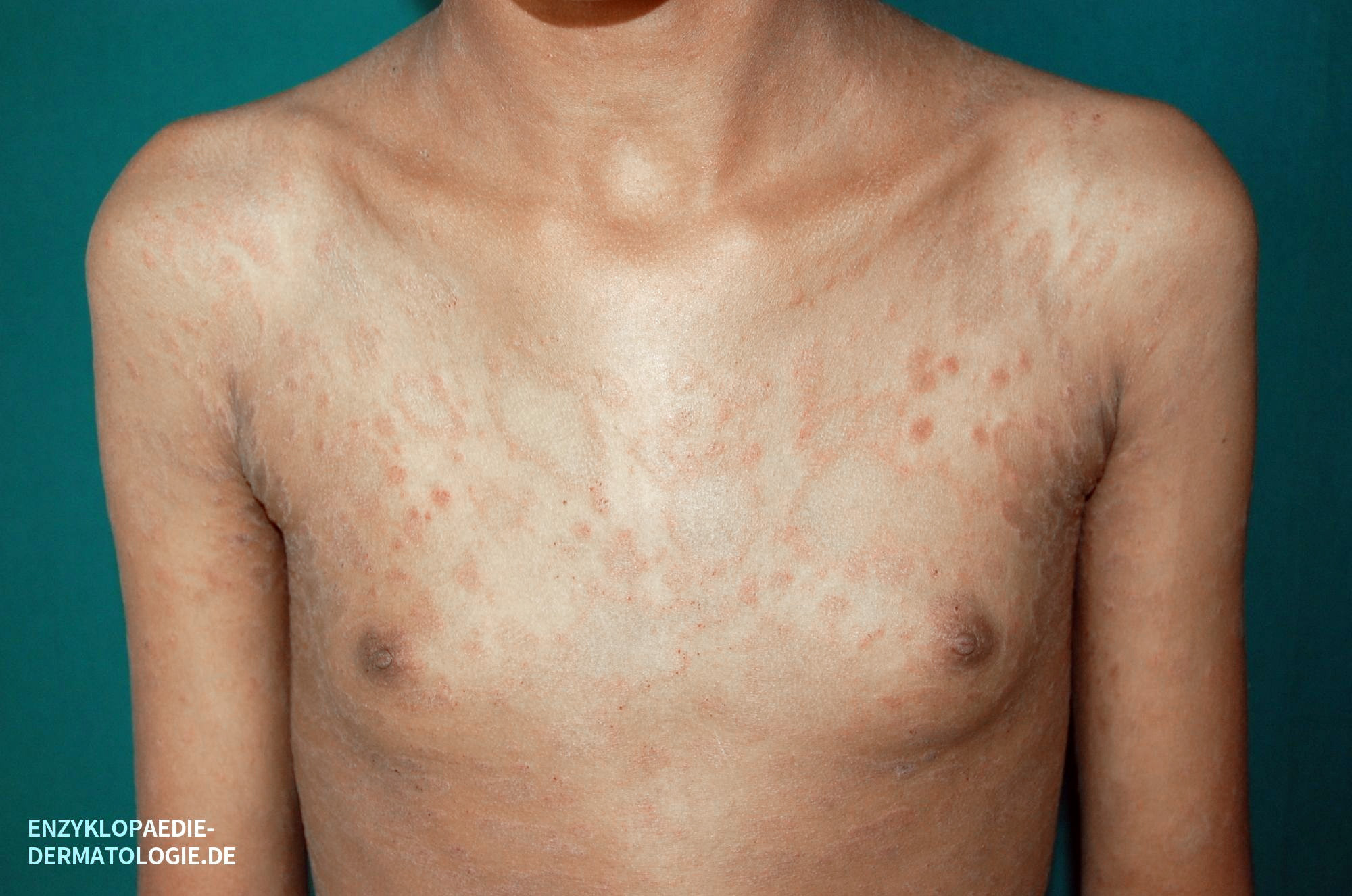 Röschenflechte (Pityriasis rosea) - Dr. med Ottmar Bogenschütz - Balingen