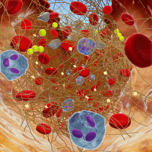 La malattia di La Peyronie - Dr Carlo Negro - Urologo, andrologo