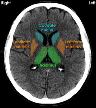 lentiform nucleus stroke